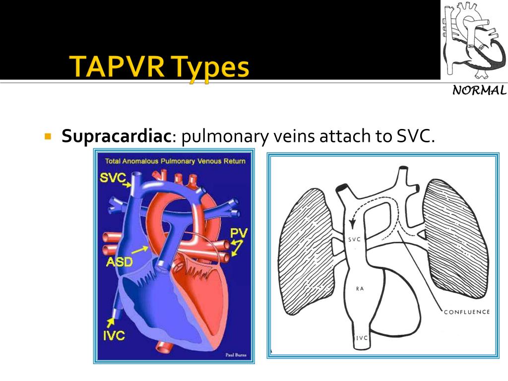PPT - Cardiac Surgical Anomalies in the Neonate PowerPoint Presentation ...