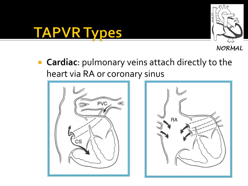 PPT - Cardiac Surgical Anomalies in the Neonate PowerPoint Presentation ...