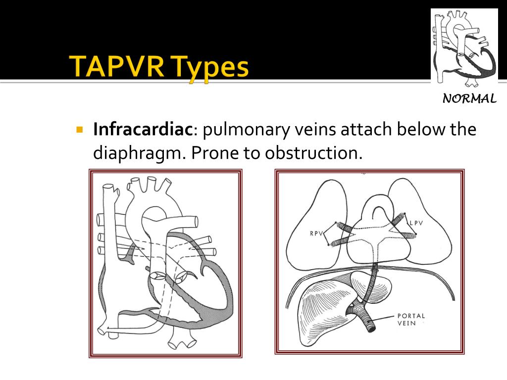 PPT - Cardiac Surgical Anomalies in the Neonate PowerPoint Presentation ...