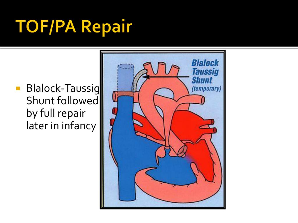 PPT - Cardiac Surgical Anomalies in the Neonate PowerPoint Presentation ...