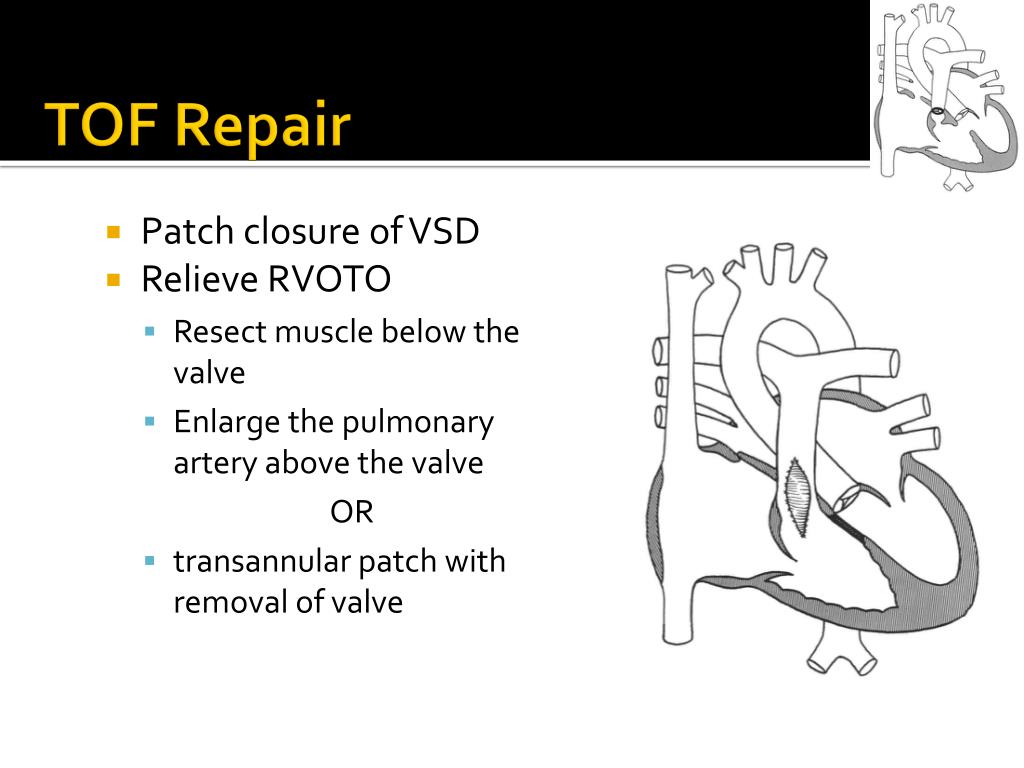 PPT - Cardiac Surgical Anomalies in the Neonate PowerPoint Presentation ...