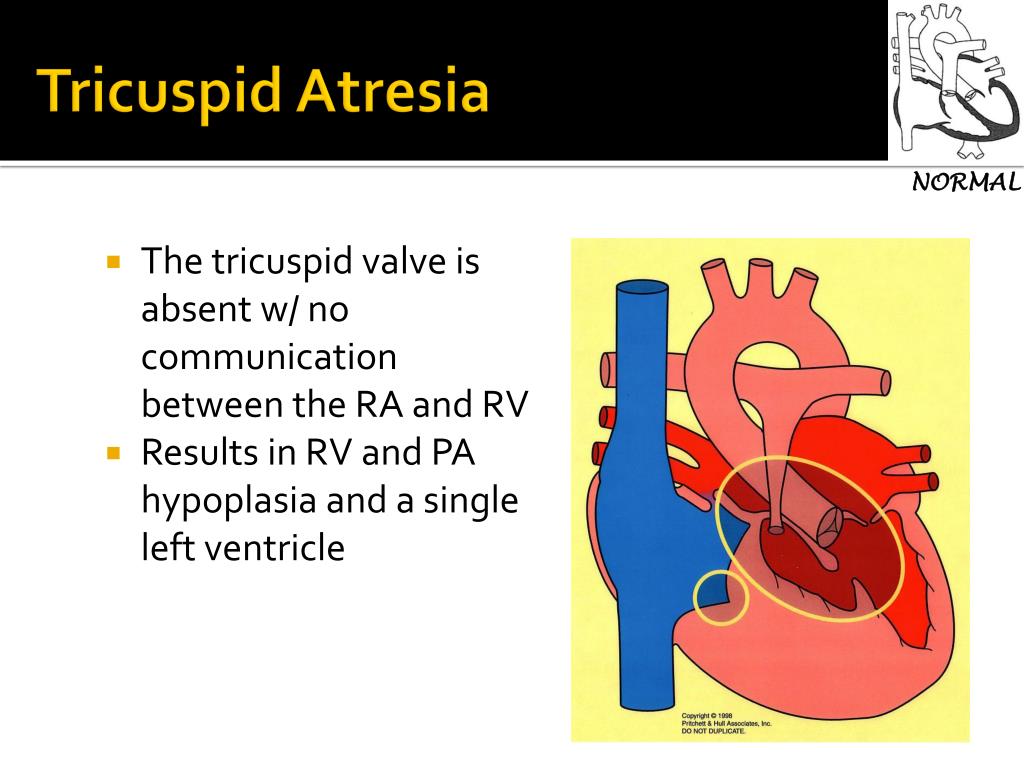 PPT - Cardiac Surgical Anomalies in the Neonate PowerPoint Presentation ...
