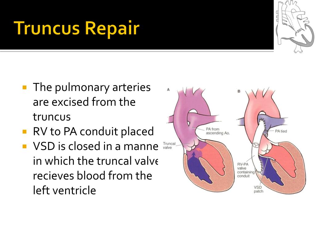 PPT - Cardiac Surgical Anomalies in the Neonate PowerPoint Presentation ...