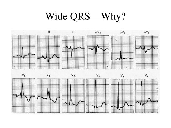 PPT - EKG 101 PowerPoint Presentation - ID:3221620