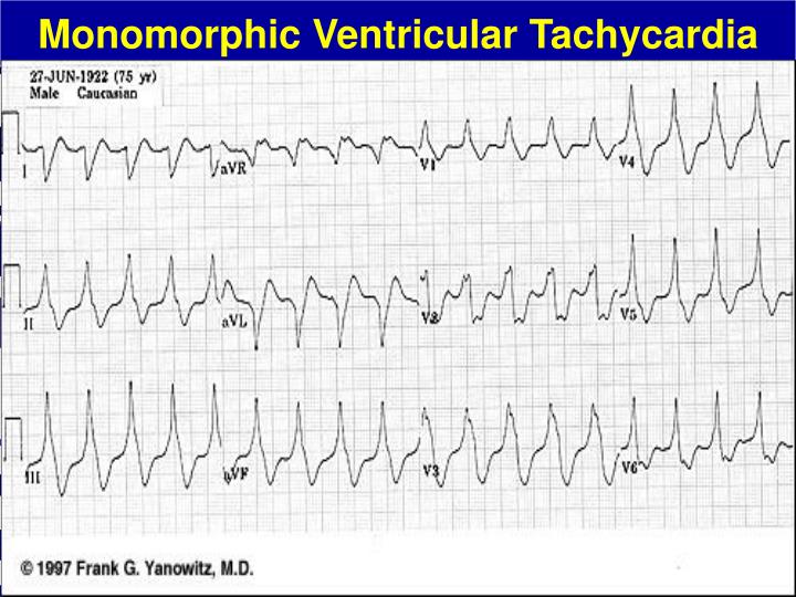 PPT - ECG Lectures Wide Complex Tachycardias Selim Krim, MD Assistant ...