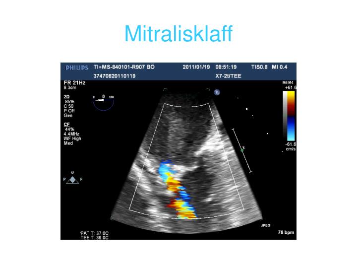 PPT - KLAFFVITIER Barbro Österlund MD, PhD PowerPoint Presentation - ID ...