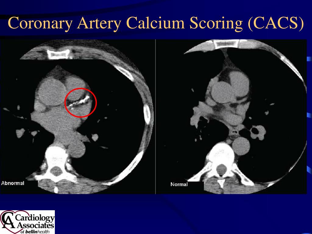 PPT - James Rider, MD FACC Cardiology Associates of Bellin Health ...