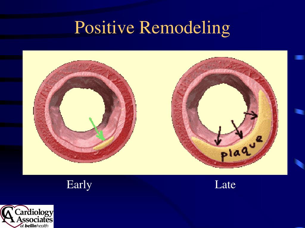 PPT - James Rider, MD FACC Cardiology Associates of Bellin Health ...