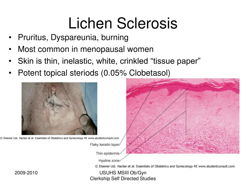 PPT - Vulvar / Vaginal Disease Ch 19, 23, 41 PowerPoint Presentation ...