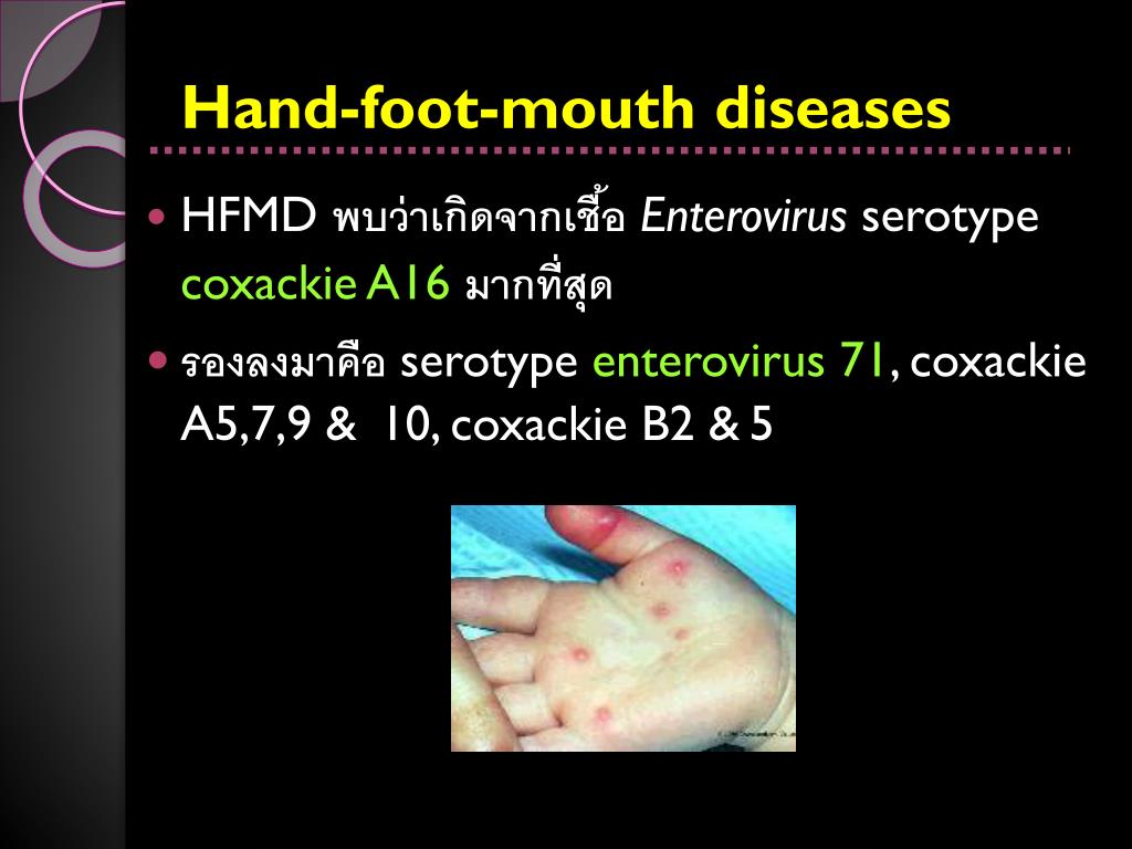 PPT - Hand-Foot-Mouth Disease/ Enterovirus 71 PowerPoint Presentation ...
