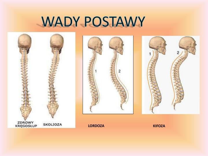 PPT - CHOROBY APARATU RUCHU PowerPoint Presentation - ID:3228713