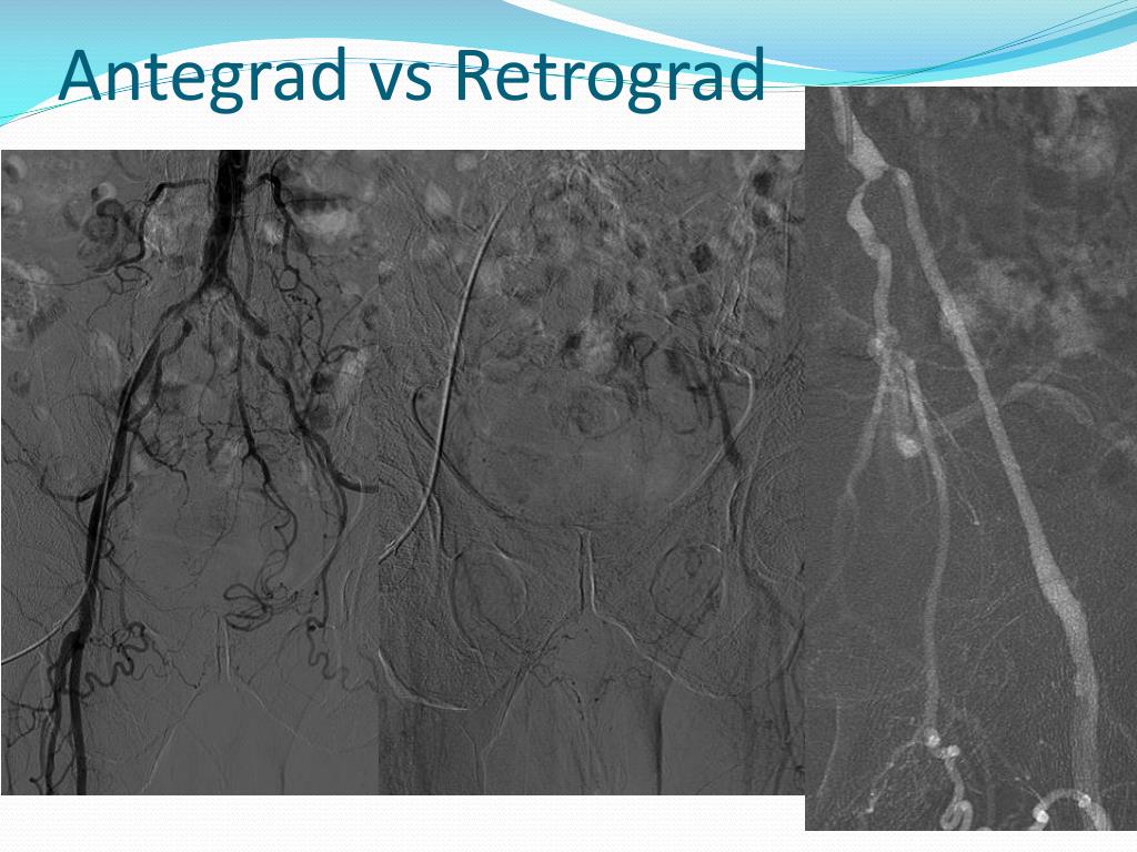 PPT - İLİOFEMORAL ARTERLERİN TIKAYICI HASTALIKLARI PowerPoint ...