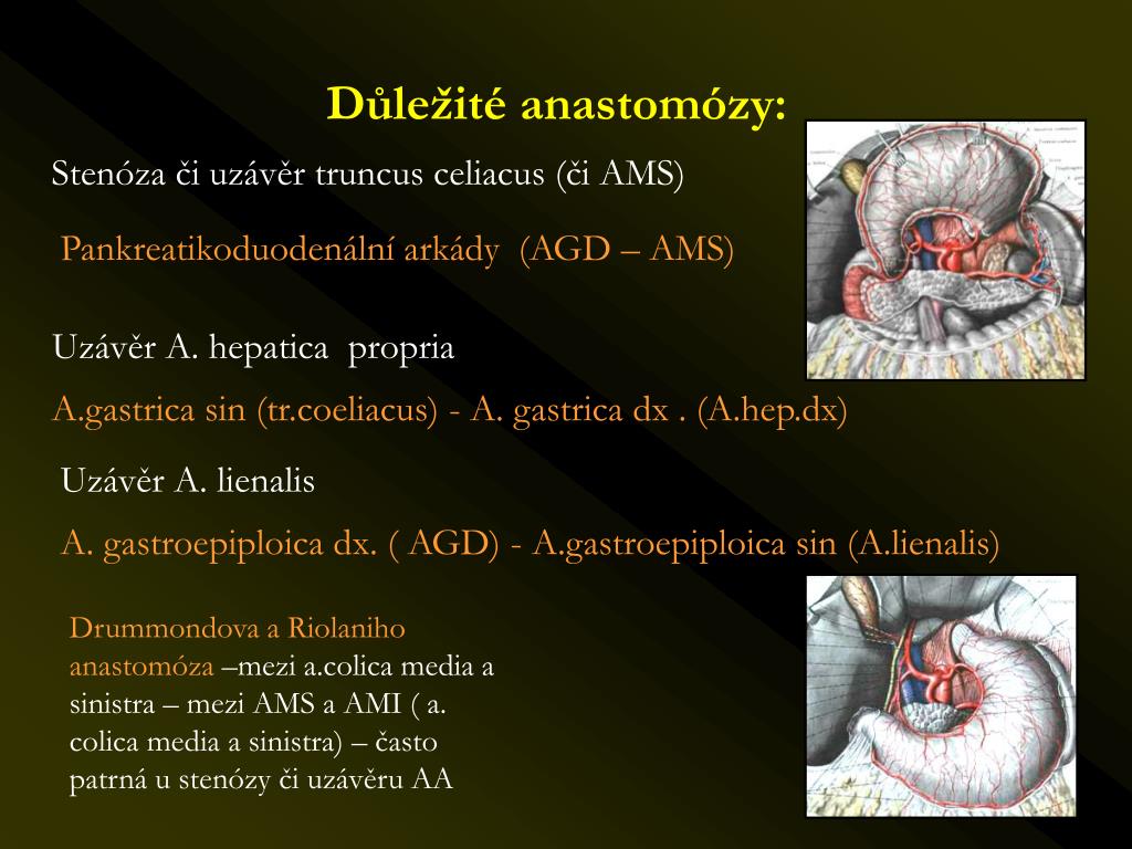 PPT - Nevariceální krvácení do GIT radiologická diagnostika a léčba ...