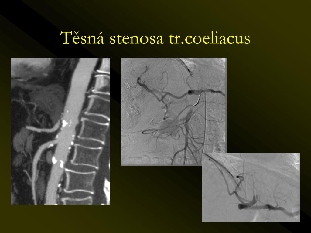 PPT - Nevariceální krvácení do GIT radiologická diagnostika a léčba ...