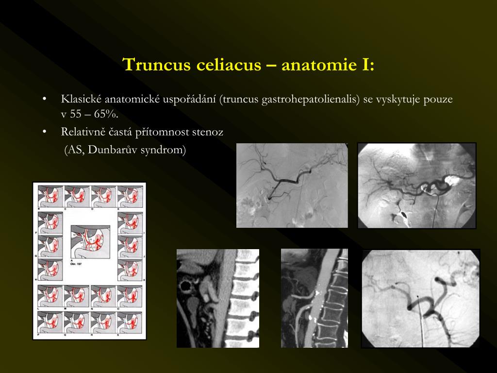 PPT - Nevariceální krvácení do GIT radiologická diagnostika a léčba ...