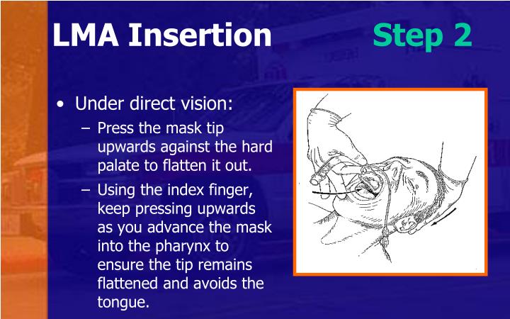 PPT - Laryngeal Mask Airways (LMA) Indications and Use for the Pre ...