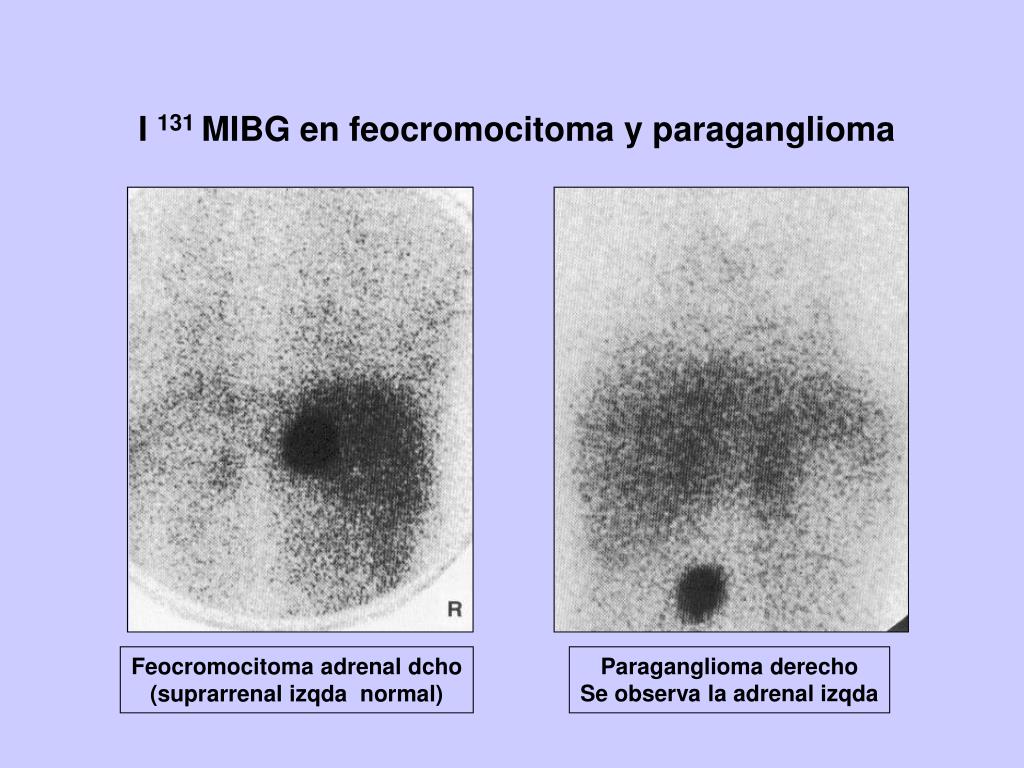 PPT - Hipertensión de causa endocrinológica Hiperaldosteronismo ...