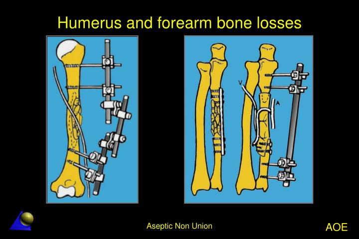 PPT - Aseptic Non-Union PowerPoint Presentation - ID:3255866