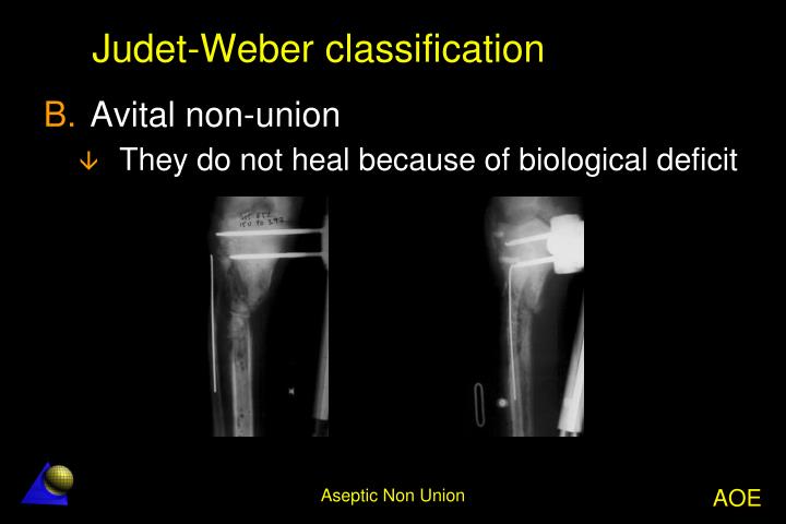 PPT - Aseptic Non-Union PowerPoint Presentation - ID:3255866