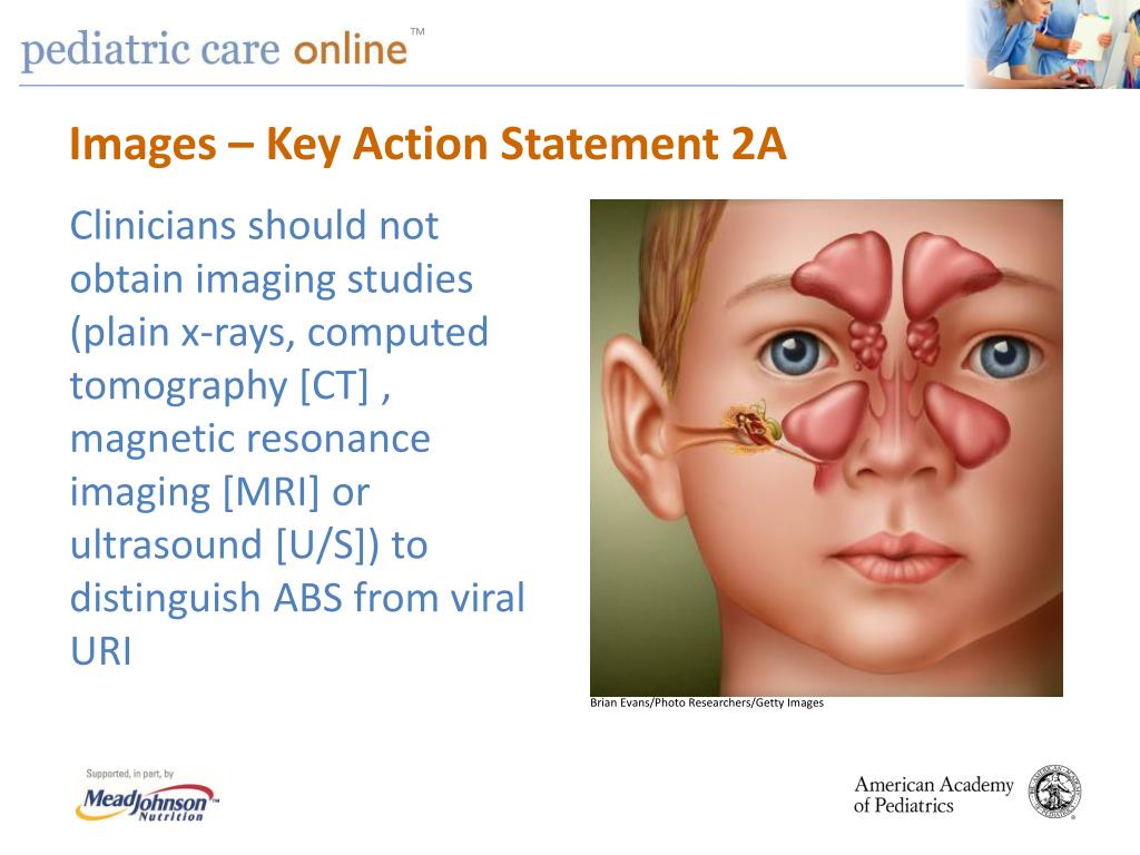 PPT - Diagnosis and Management of Acute Bacterial Sinusitis: 2013 AAP ...
