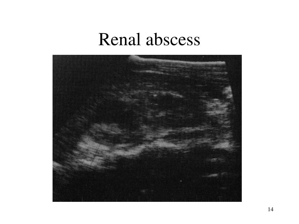 PPT - Urnary tract infectin, Acute pyelonephritis Renal and perirenal ...