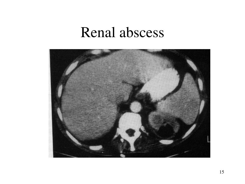 PPT - Urnary tract infectin, Acute pyelonephritis Renal and perirenal ...