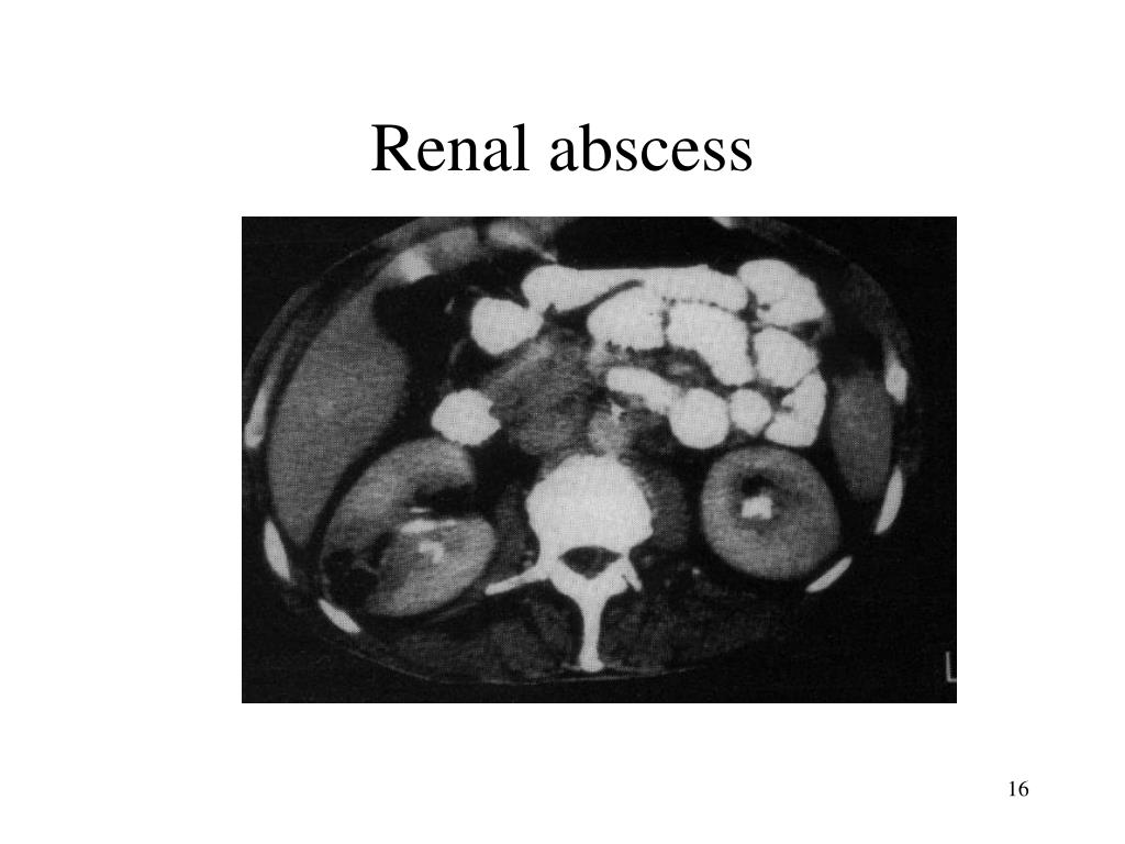 PPT - Urnary tract infectin, Acute pyelonephritis Renal and perirenal ...