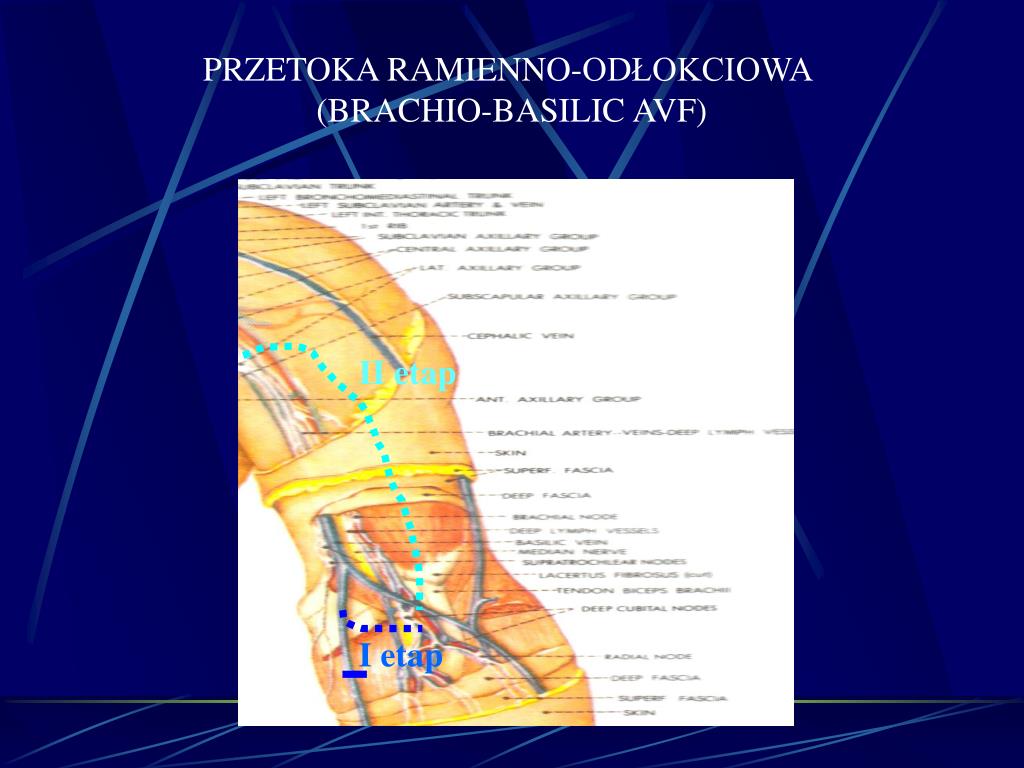 PPT - DOSTĘP NACZYNIOWY DO HEMODIALIZY PowerPoint Presentation, free ...