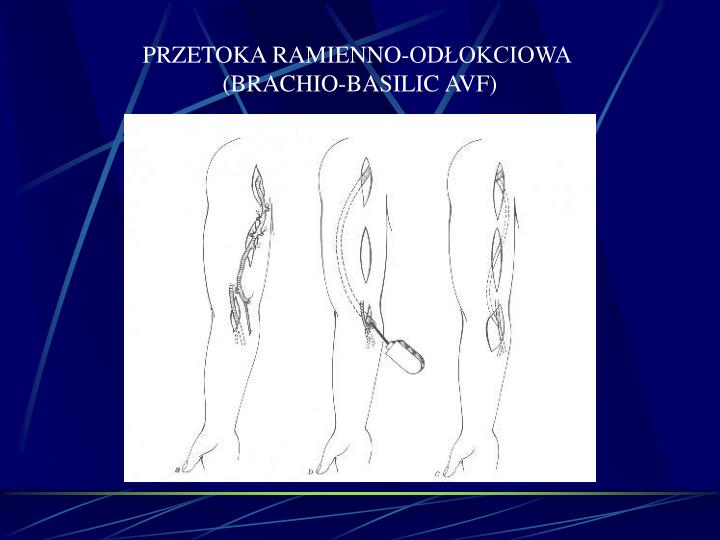 PPT - DOSTĘP NACZYNIOWY DO HEMODIALIZY PowerPoint Presentation - ID:3257144