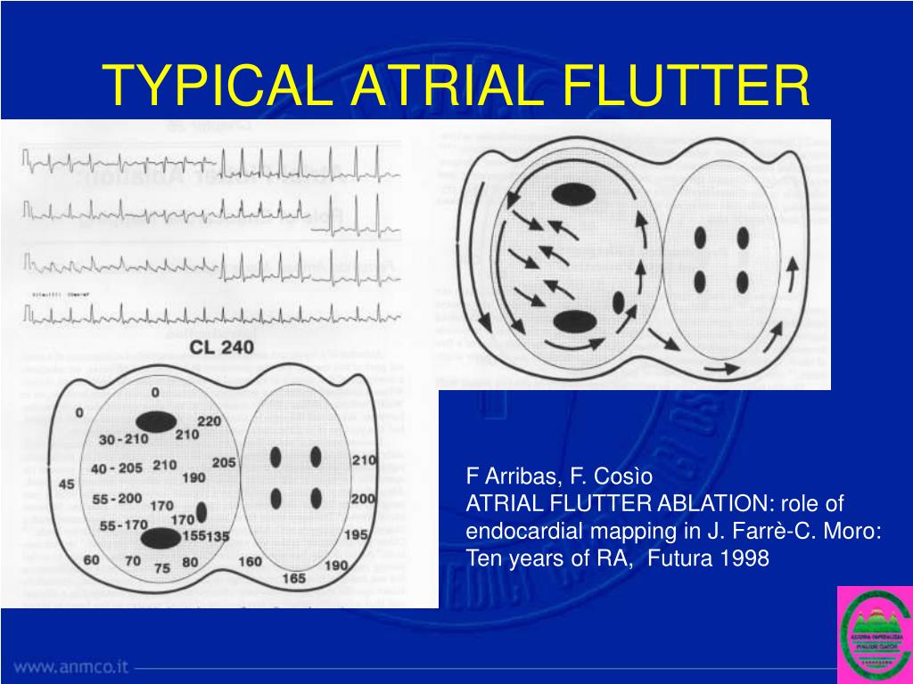 Atrial flutter ablation endoscopy - meryenergy