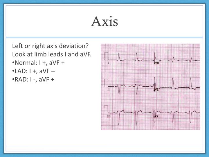 PPT - ECG for Interns PowerPoint Presentation - ID:3257186