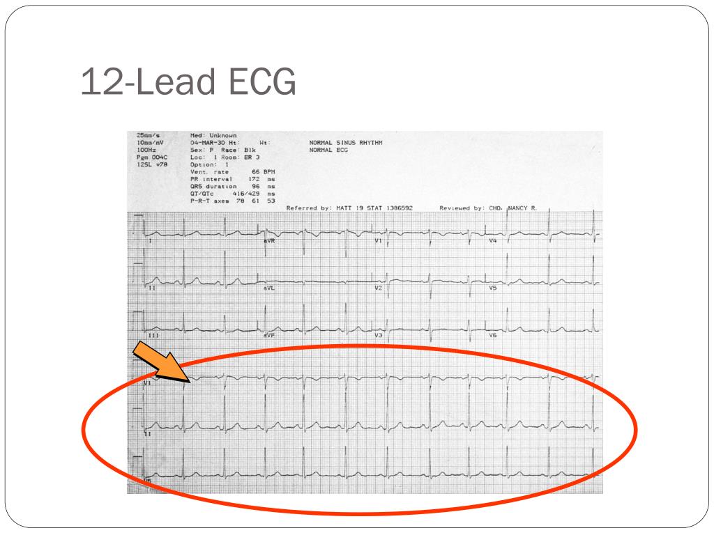 PPT - The 12 Lead ECG in Acute Coronary Syndromes PowerPoint ...