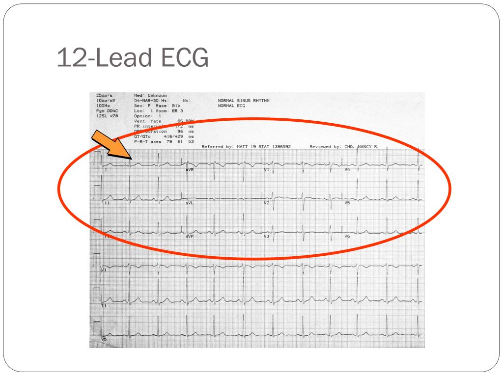 PPT - The 12 Lead ECG in Acute Coronary Syndromes PowerPoint ...