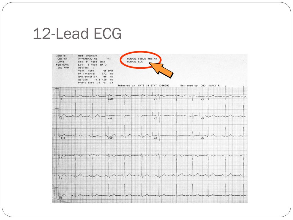 PPT - The 12 Lead ECG in Acute Coronary Syndromes PowerPoint ...