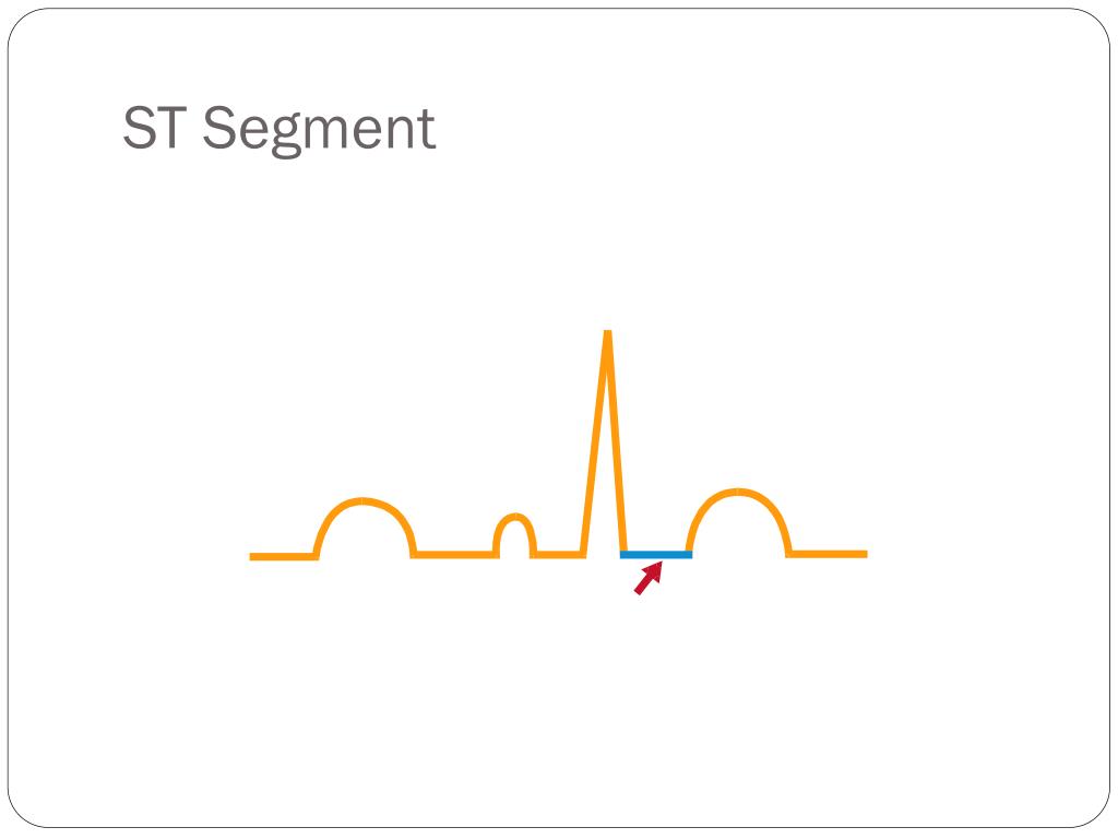 PPT - The 12 Lead ECG in Acute Coronary Syndromes PowerPoint ...