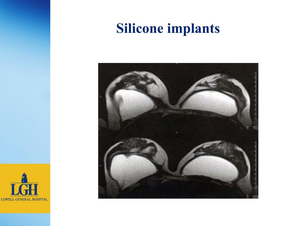 PPT - Breast MRI at Lowell General Hospital PowerPoint Presentation ...