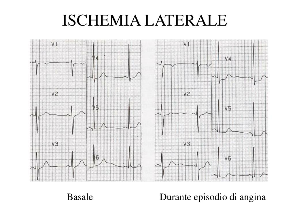 PPT - ELETTROCARDIOGRAMMA (ECG O EKG) PATOLOGICO PowerPoint ...