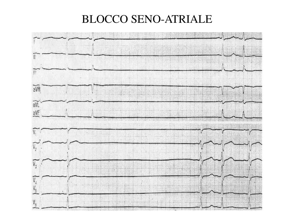 PPT - ELETTROCARDIOGRAMMA (ECG O EKG) PATOLOGICO PowerPoint ...