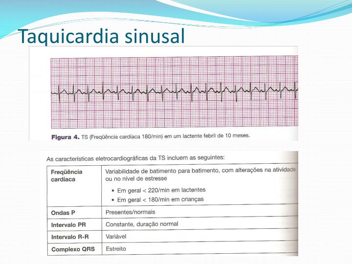 PPT - Arritmias cardíacas PowerPoint Presentation - ID:3260407