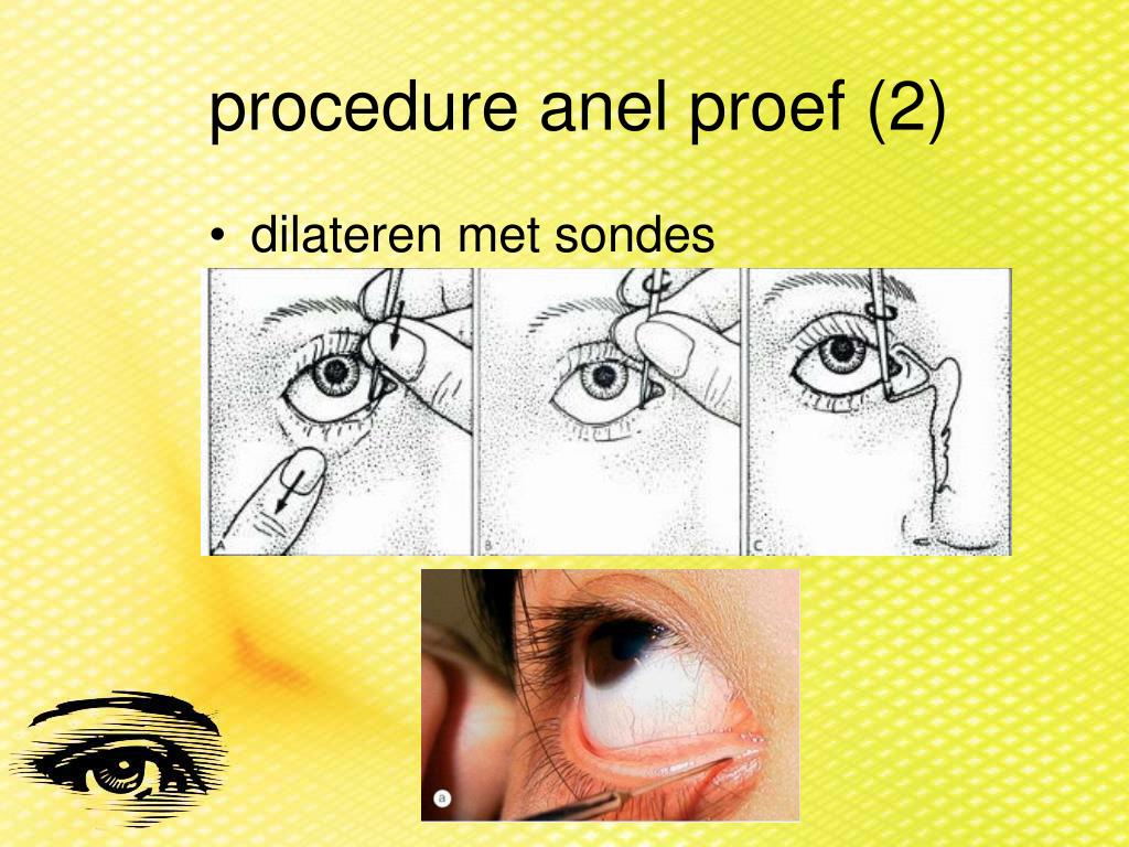 PPT - proef van Anel (dilatation&irrigation lacrimal duct) PowerPoint ...