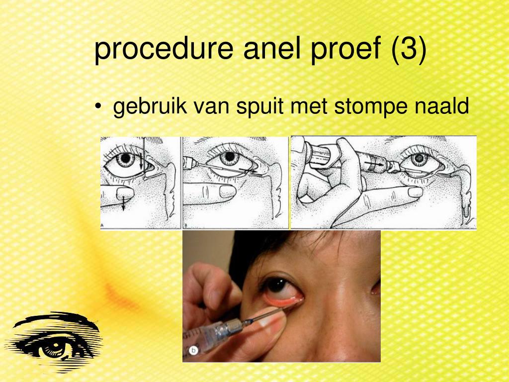 PPT - proef van Anel (dilatation&irrigation lacrimal duct) PowerPoint ...