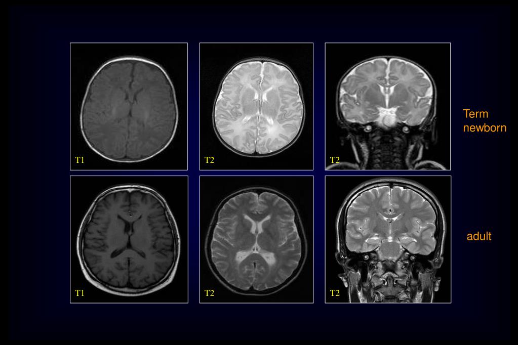 PPT - SSD Neuroradiology Department of Radiology S. CROCE Hospital ...