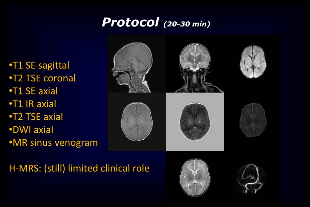 PPT - SSD Neuroradiology Department of Radiology S. CROCE Hospital ...