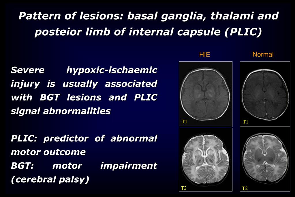 PPT - SSD Neuroradiology Department of Radiology S. CROCE Hospital ...