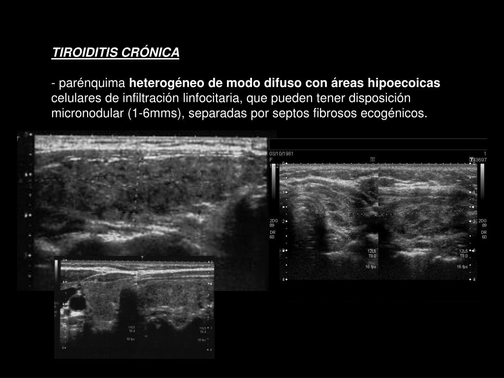 PPT - volumen tiroides: 0,5 x diámetro L x diámetro T x diámetro AP en ...