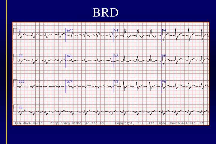 PPT - BLOQUEIO DE RAMO PowerPoint Presentation - ID:3263759