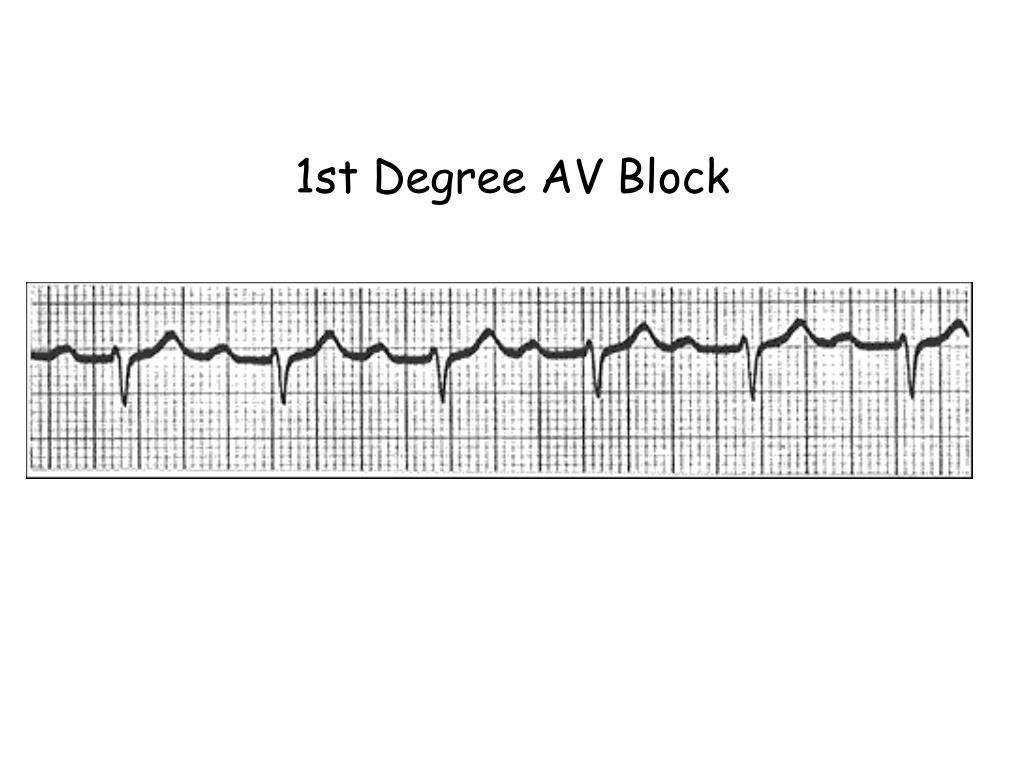 PPT - BLOCCHI ATRIO-VENTRICOLARI (BAV) BAV 1° GRADO (incompleto o ...