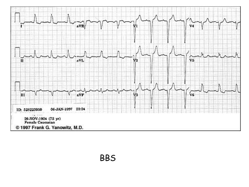 PPT - BLOCCHI ATRIO-VENTRICOLARI (BAV) BAV 1° GRADO (incompleto o ...
