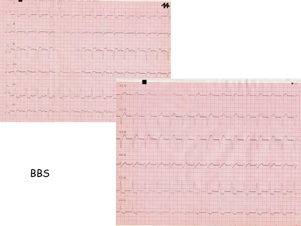 PPT - BLOCCHI ATRIO-VENTRICOLARI (BAV) BAV 1° GRADO (incompleto o ...