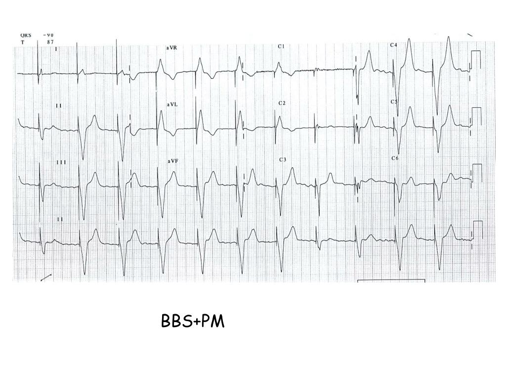 PPT - BLOCCHI ATRIO-VENTRICOLARI (BAV) BAV 1° GRADO (incompleto o ...